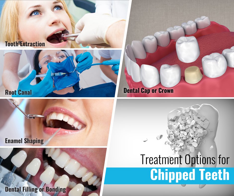 How to Deal With a Chipped Tooth Emergency - Longevity LIVE