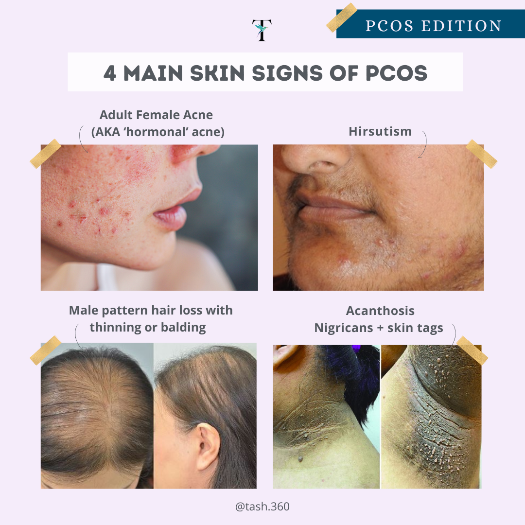 Dermatologist Explains Link Between PCOS and Your Skin | Longevity