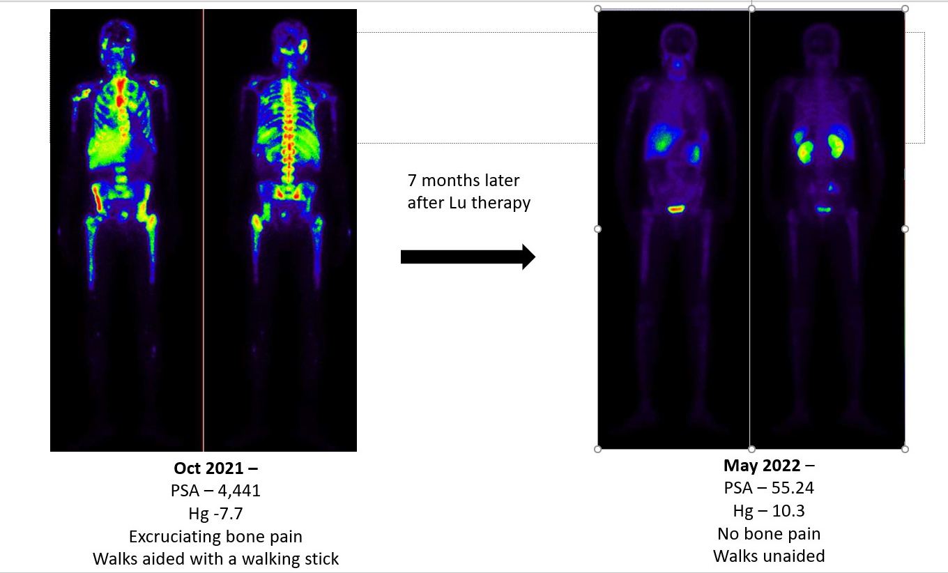 UFS Nuclear Medicine Unit Successfully Treats Patient with Advanced ...